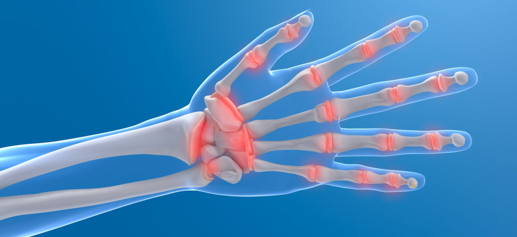 Artralgia: Definición, Síntomas y Tratamientos - Blog Iberomed